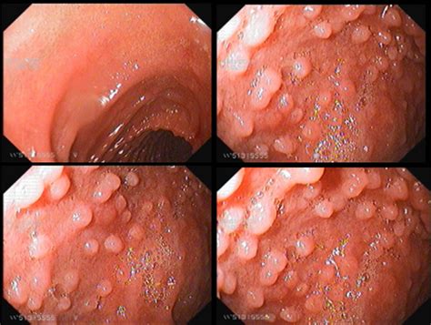 Diffuse Duodenal Nodular Lymphoid Hyperplasia 35 Year Male Presented Download Scientific