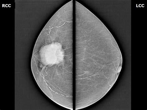 Atlas Of Breast Cancer Early Detection