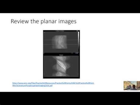 Tc PYP Scan For A TTR Cardiac Amyloid YouTube