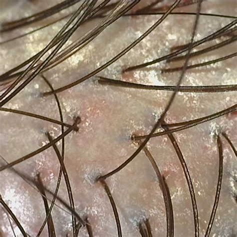 Oily Scalp Drscalp