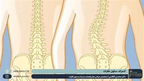 انحراف ستون فقرات علل، علائم موثر در تشخیص و روش‌ های درمان بیماری