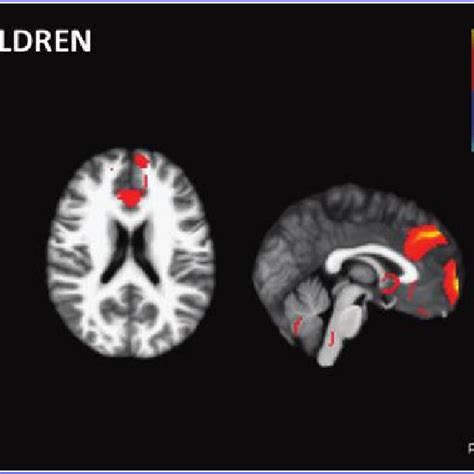 Voxel Wise Signed Differential Mapping Metaanalysis Of The Default Mode Download Scientific