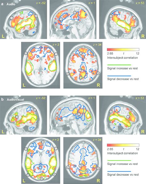 A Auditory Speech Comprehension Five Slices Are Shown With Mni