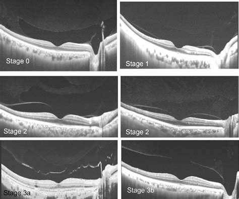 Evolution Of Physiological Posterior Vitreous Detachment Pvd Stage 0