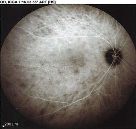 Initial Examination Of The Right Eye Color Fundus Photo Shows