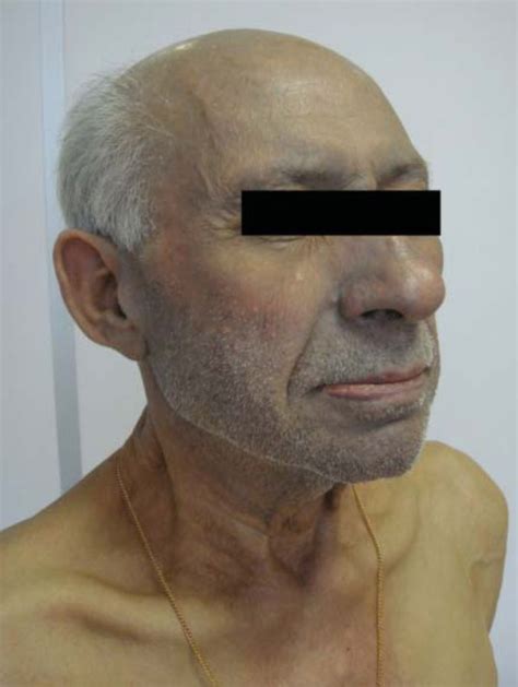 Hemochromatosis Skin Discoloration