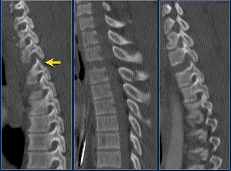 The Radiology Assistant Spine Fractures Tlics Classification