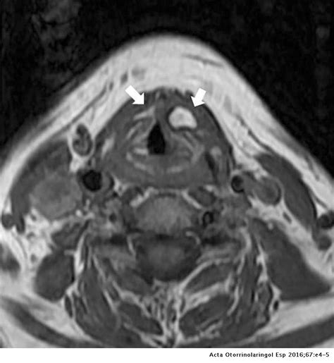 Bilateral Dystrophic Ossification Of The Thyroid Cartilage Acta