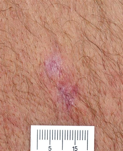 Primary Cutaneous Marginal Zone B Cell Lymphoma In Monozygotic Twins