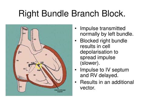 Ppt Ventricular Conduction Disorders Powerpoint Presentation Id