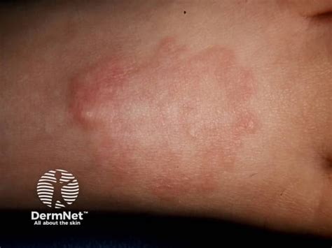 Granuloma Annulare Dermnet