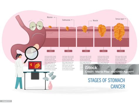 Stages Of Stomach Cancer Explained Visuallynfographic Showing The
