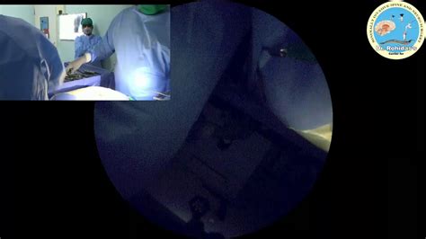 Endoscopic Discectomy L4 L5 At Eula Seay Blog