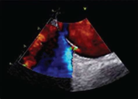 A Contrast Transcranial Doppler Ctcd Detected Large Right To Left