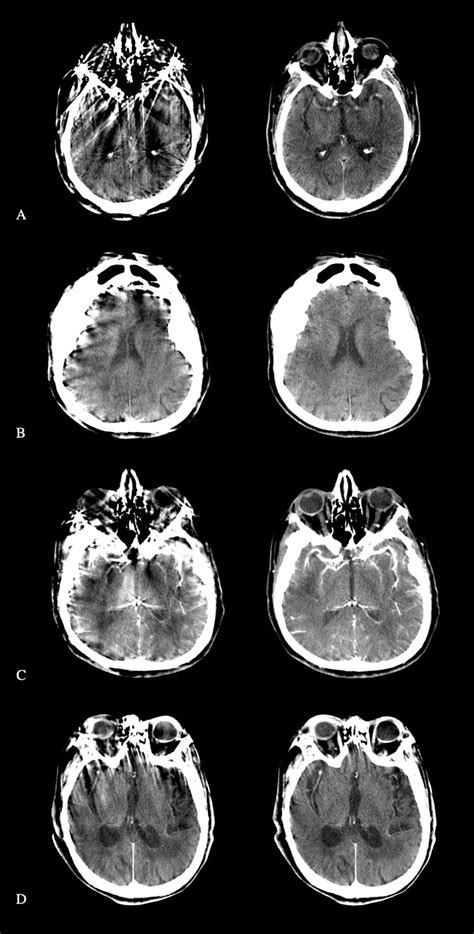 Mri Motion Artifact Correction At Hudson Facy Blog