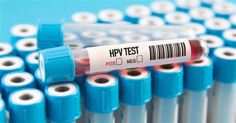 Decoding The Hpv Dna Test Your Key To Cervical Cancer Prevention