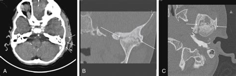 Temporal Bone Inflammatory And Infectious Diseases Radiology Key