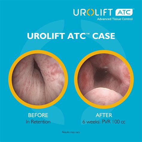 Urolift® System By Teleflex Interventional Urology On Linkedin Help