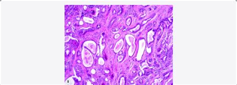 Ceruminous Adenoma Exhibiting Glandular Architecture With A Two Layered