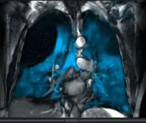 Fda Issues Expanded Pediatric Approval Of Mri Contrast Agent For Lung