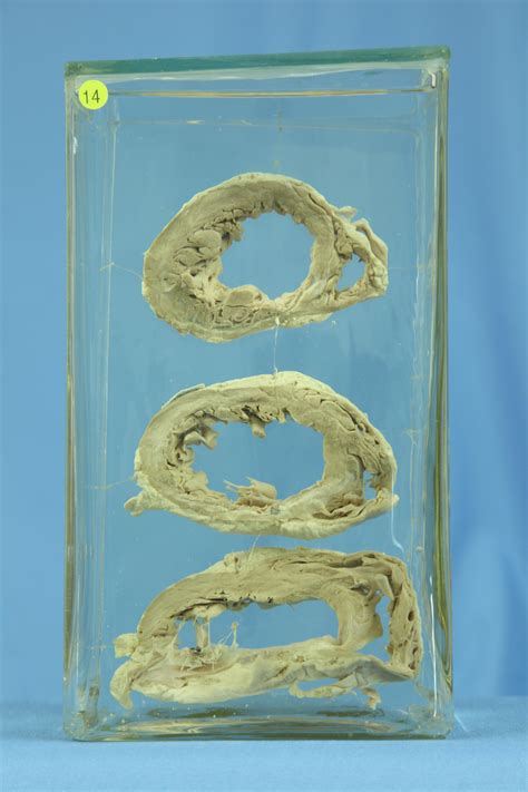 心血管疾病 34 14 冠心病伴陈旧性心肌梗死 病理标本博物馆 复旦大学基础医学院