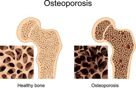 Increase Bone Mineral Density With Calcium Supplements