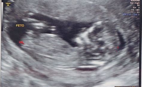 Da pra ver o sexo a partir de 12 semanas morfológica Abril de 2022 Página 7 BabyCenter