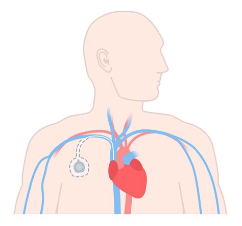 Port A Cath Placement Texoma Surgery