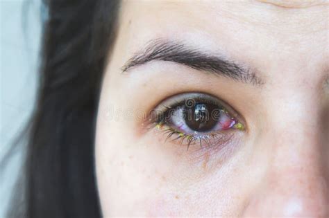 Close Up Of An Infected Eye With Redness And Yellow Discharge Symptoms