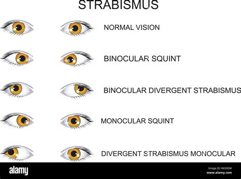 Illustration Of A Healthy Eye And Types Of Strabismus Stock Vector Image And Art Alamy