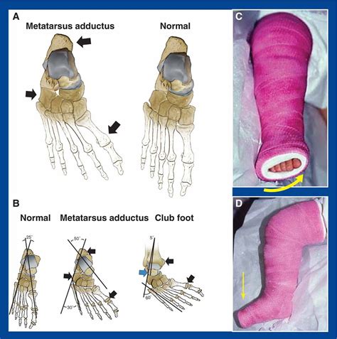 Foot Orthotics For Metatarsus Adductus At Lilian Dixson Blog