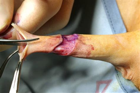 Adult Male Circumcision In Malaysia Risks Benefits And Recovery