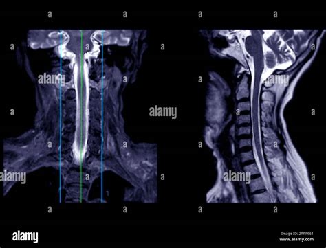 Mri Of C Spine Or Magnetic Resonance Image Of Cervical Spine Sagittal View For Diagnosis