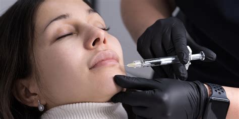 Lip Filler Migration Time To Dissolve Lip Filler