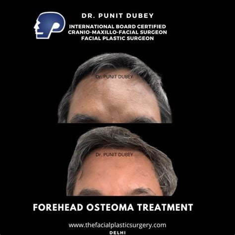 Osteoma Forehead Treatment In Delhi