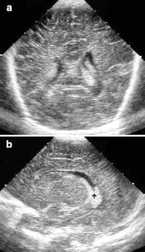 A B Split Choroid Plexus A Coronal View In A Full Term Newborn