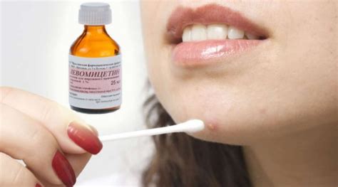 გამონაყარი სწრაფადვე გაქრება თუ ამ ხელმისაწვდომ საშუალებას გამოიყენებთ