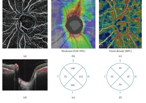 Figure 1 From Correlation Analysis Between Nerve Fiber Layer Thickness And Peripapillary Vessel