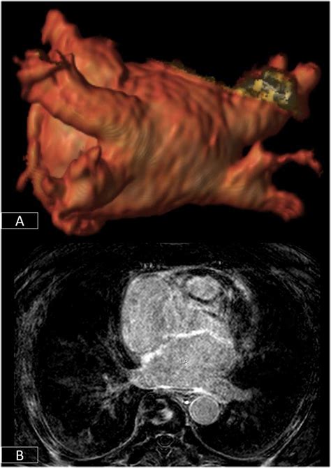 3d segmentation of the left atrium depicting left atrial anatomy and