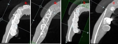 Mandibular Canal On Skull Facial Bone Anatomy Overview Mandible