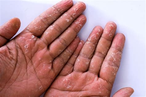 What Is Metronidazole