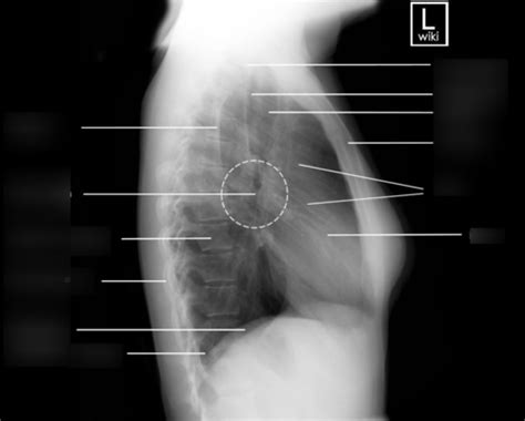 Normal Lung X Ray Lateral