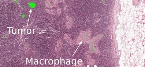 Deep Learning Helps Pathologists Detect Cancer Health Tech Insider