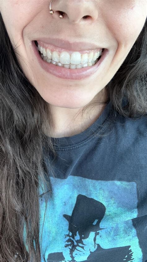 On My Last 4 Refinement Trays R Invisalign