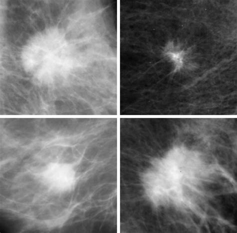 2 Examples Of Four Different Spiculated Masses As Seen On Mammography Download Scientific