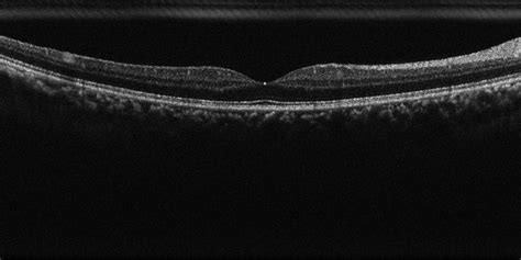 Retina Object Detection Dataset And Pre Trained Model By Retinal Detachment