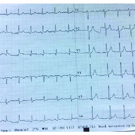 The First Electrocardiogram Of The Patient Download Scientific Diagram