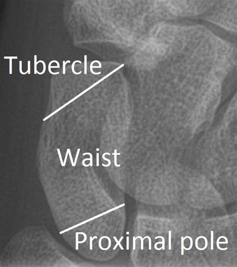 Scaphoid Fractures Scrub Book Scaphoid Fractures Scrub Book
