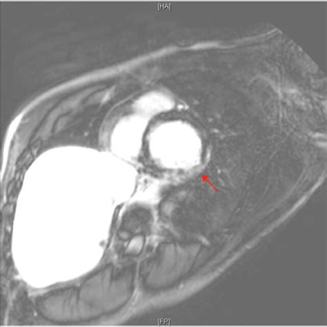 Patchy Areas Of Mid Wall Late Gadolinium Enhancement Particularly Download Scientific Diagram