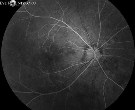 Punctate Inner Choroiditis Pic